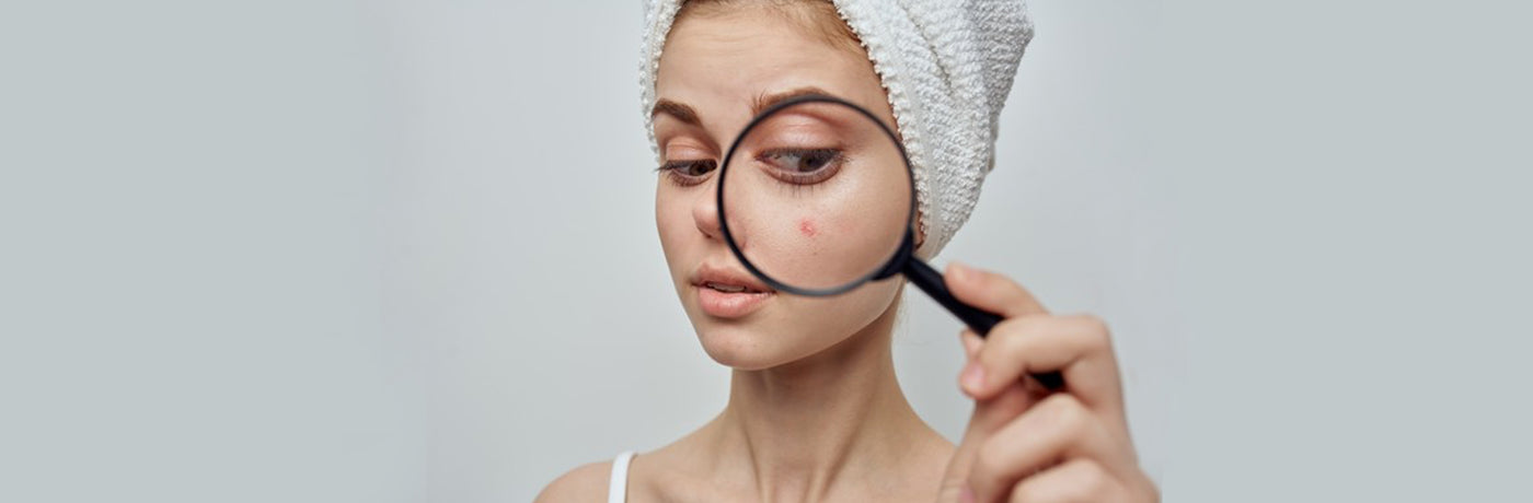 How to know if you have fungal acne and how to Treat it