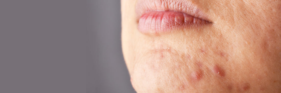 Decoding the Mystery that is PCOD and What it Can do to Your Skin