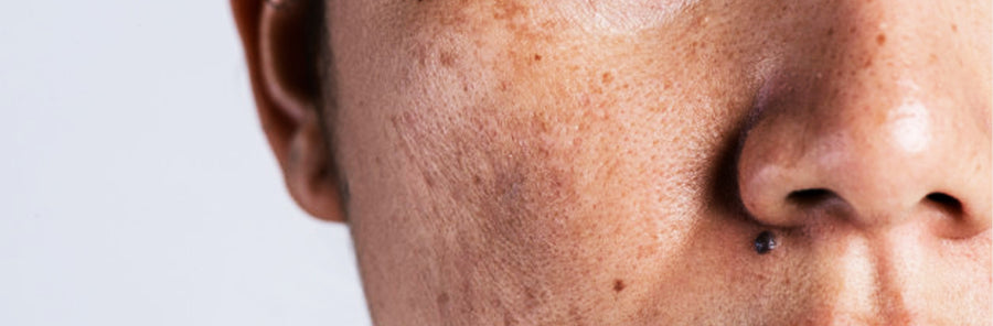 Differentiate between two types of acne marks in skincare: PIH & PIE